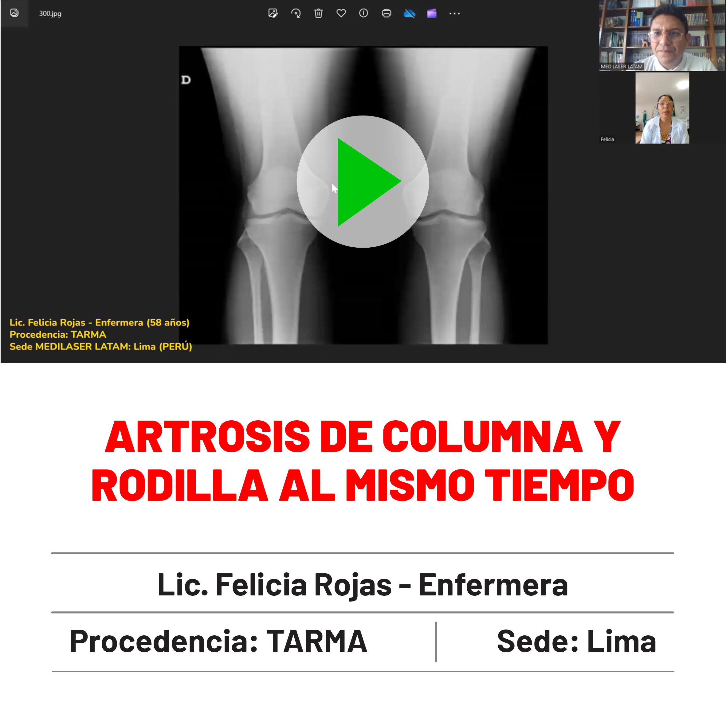 Artrosis de Columna y Rodilla al mismo tiempo | TESTIMONIO - Medilaser ...