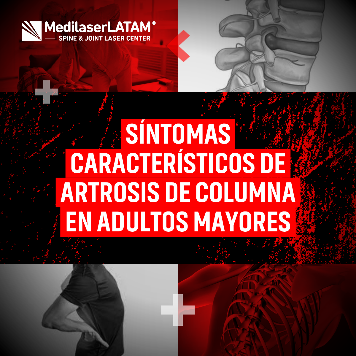 Síntomas característicos de Artrosis de Columna en adultos mayor